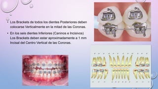 colocacion de brackets.pptx