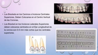 colocacion de brackets.pptx