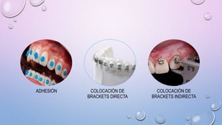 colocacion de brackets.pptx