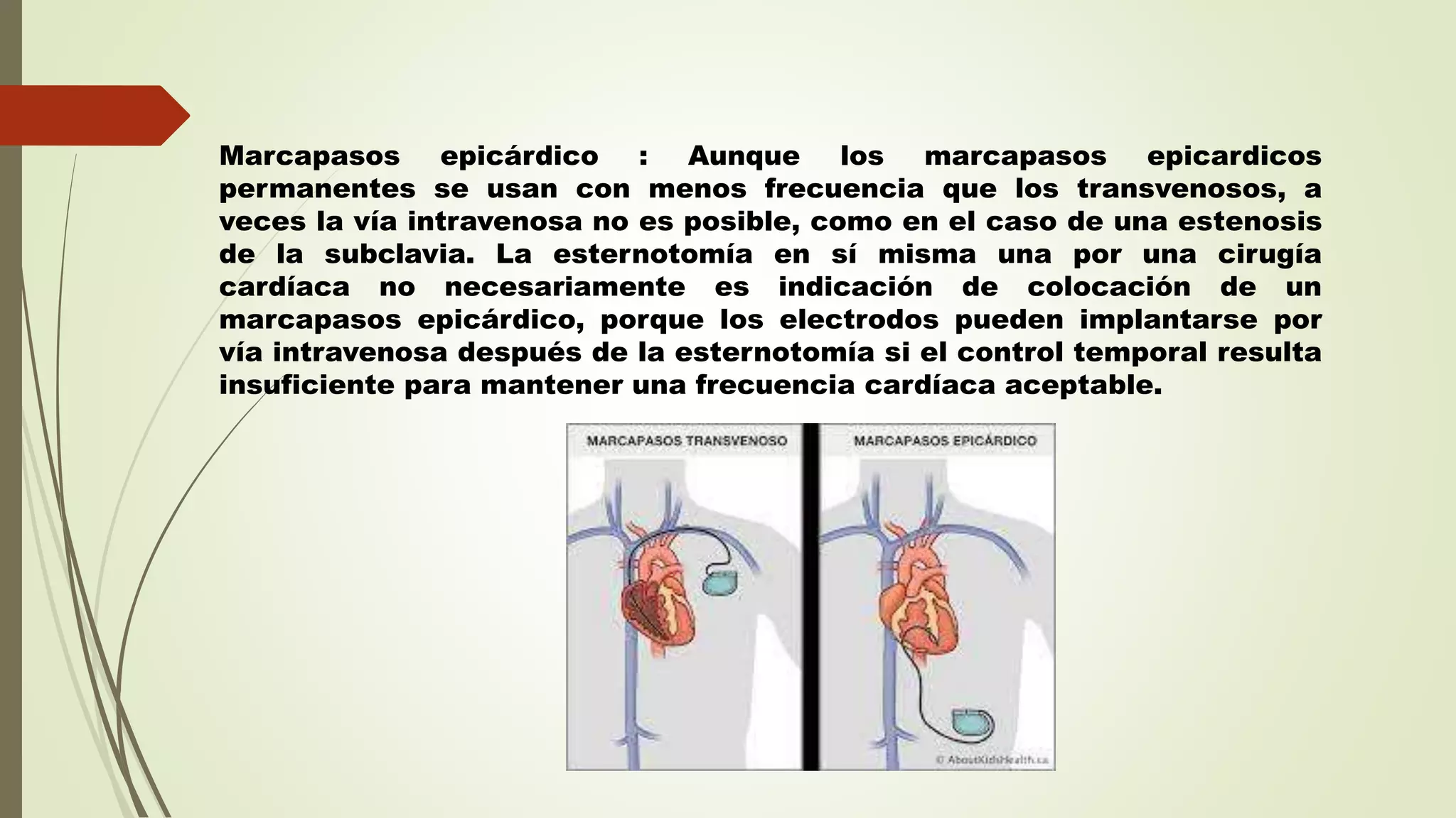 COLOCACION DE MARCAPASOS.pptx