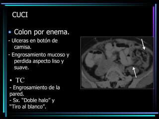 Radiología del Colon | PPT