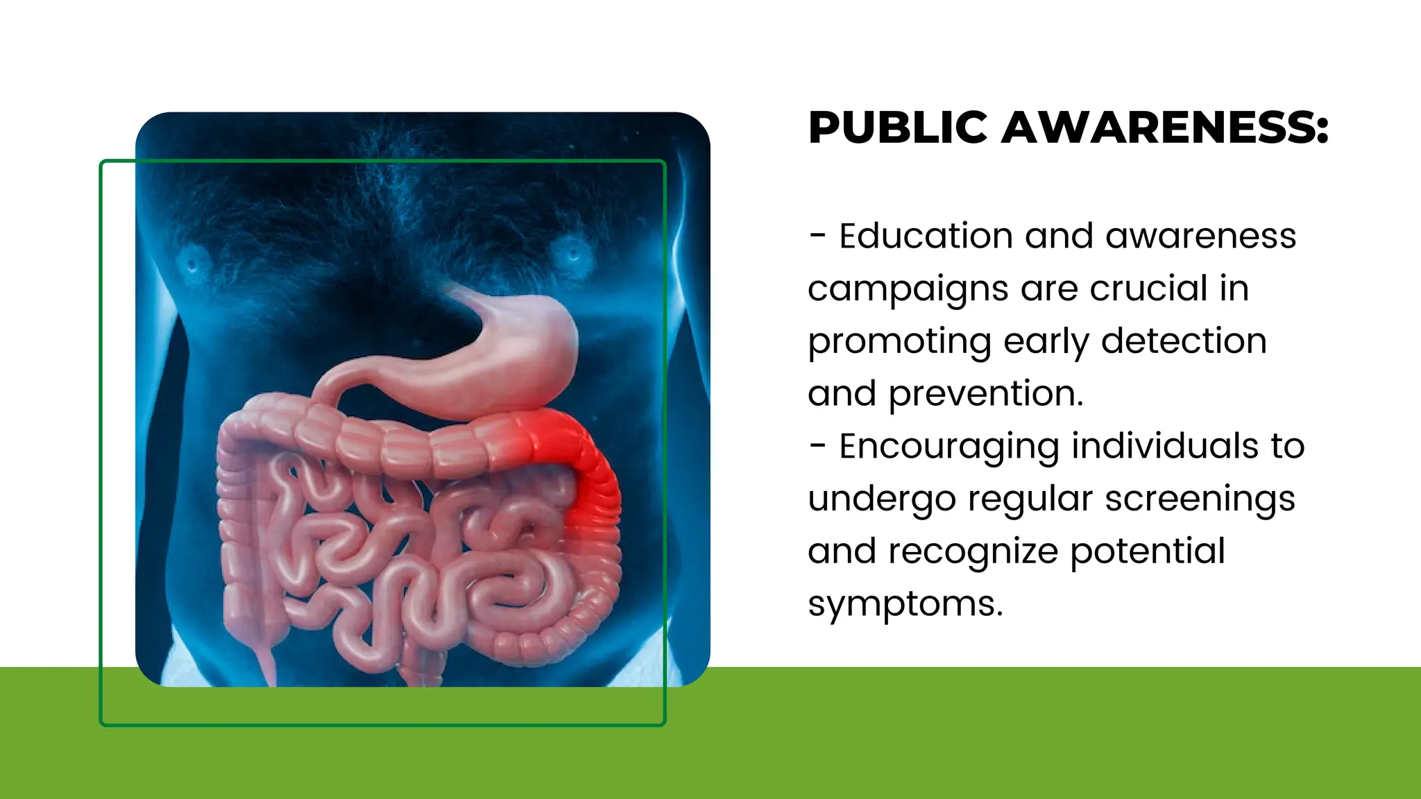 Colon Cancer PPT | PDF