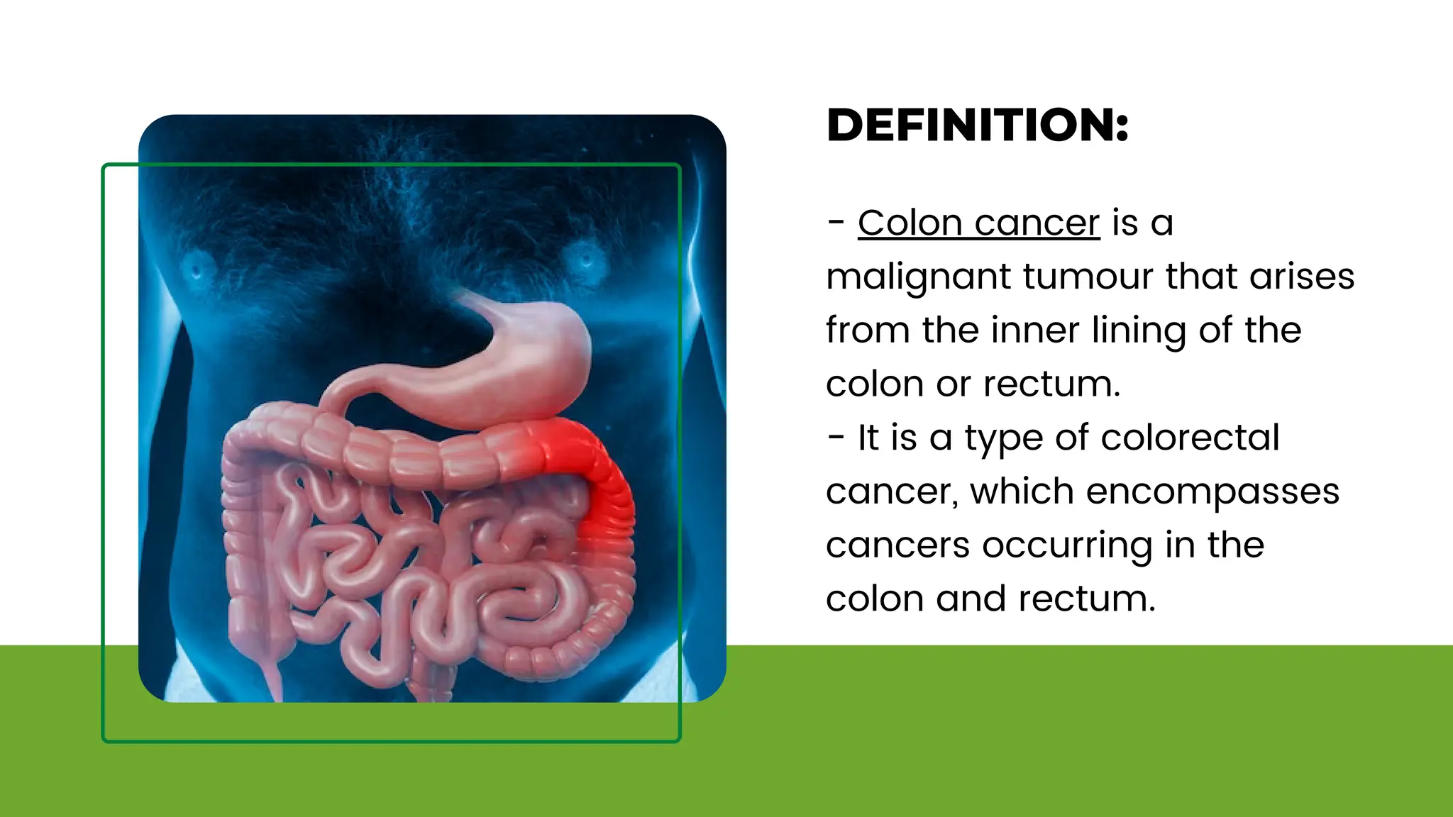 Colon Cancer PPT | PDF