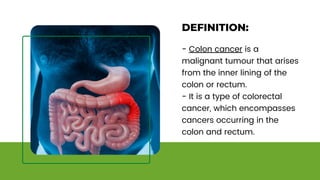Colon Cancer PPT | PDF