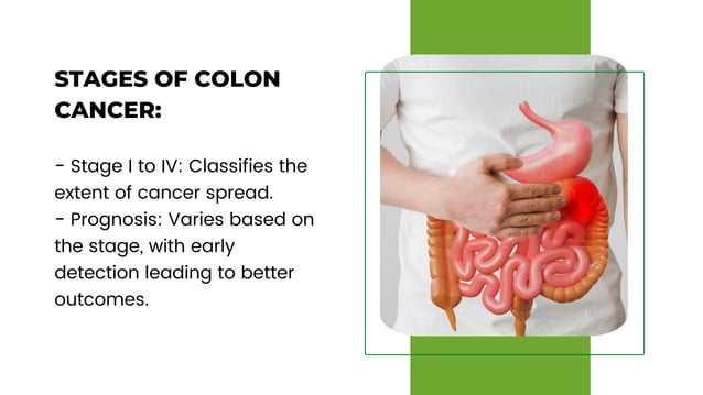 Colon Cancer PPT | PDF