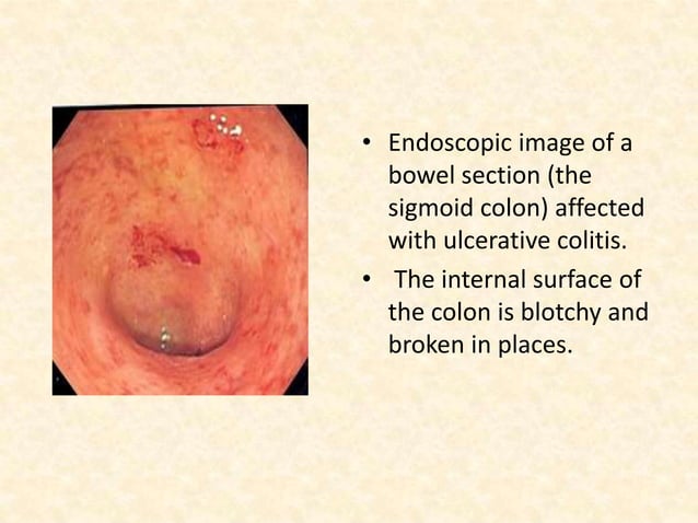 Important disorders of colon