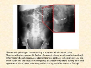 Thumbprint Sign Ischemic Colitis
