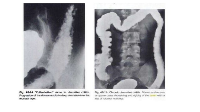 Colon a doble contraste