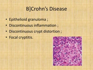 Colon biopsy naveen | PPT
