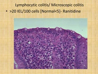 Colon biopsy naveen | PPTX