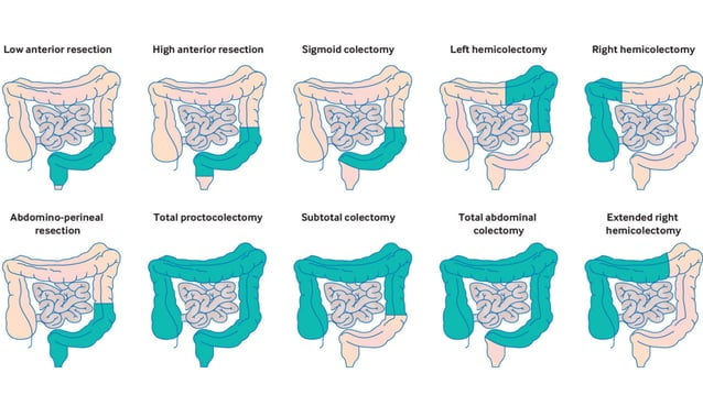 Colon bleeding approach and investigations | PPT
