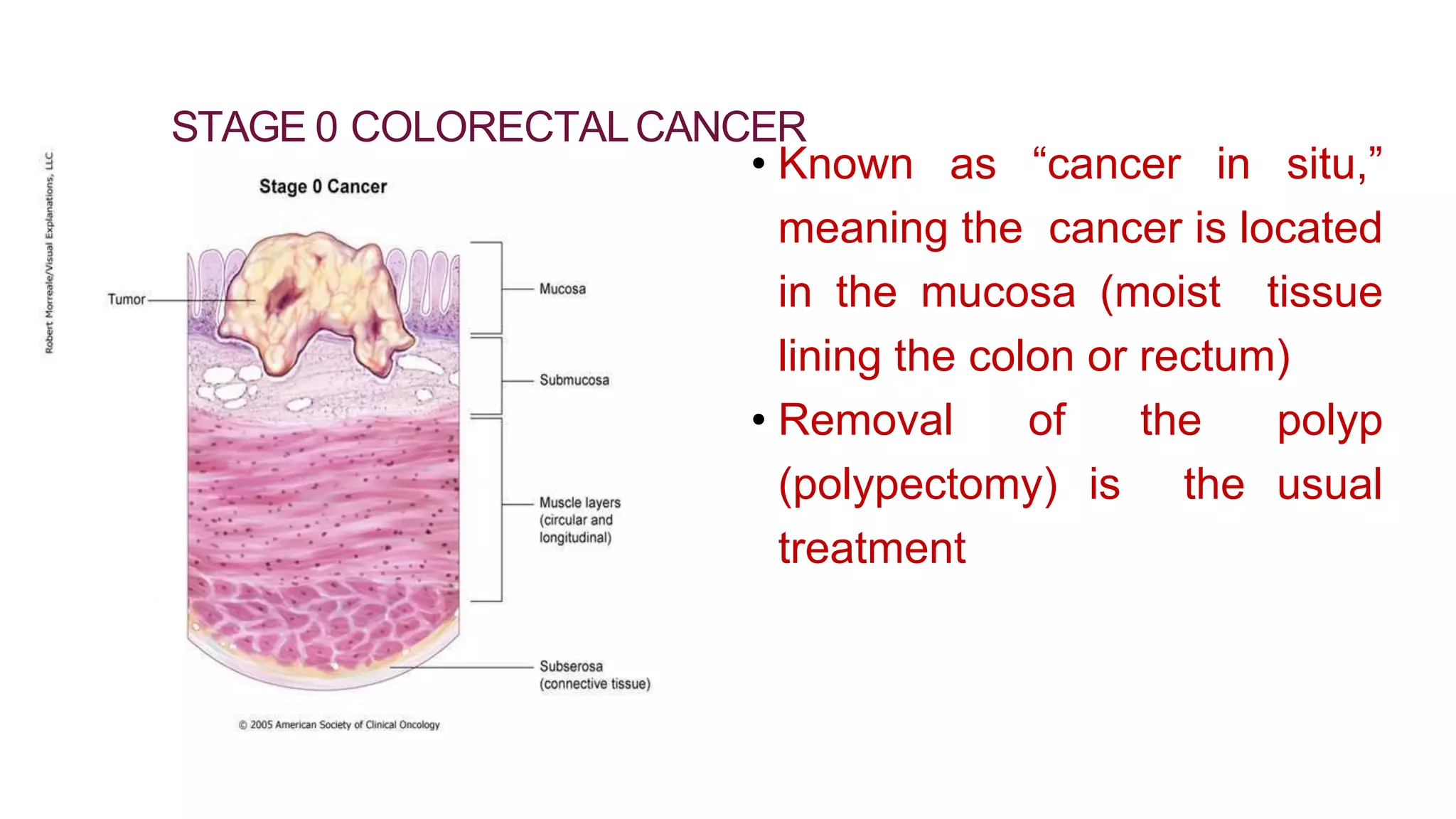 Coloncancer | PPT