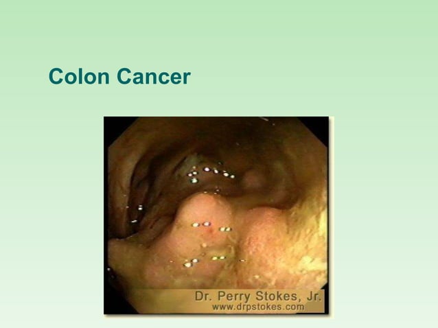 Colon cancer.ppt.pptx