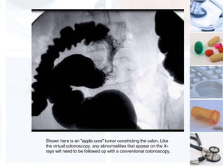Colon Cancer in a Male Patient - Case Presentation | PPTX