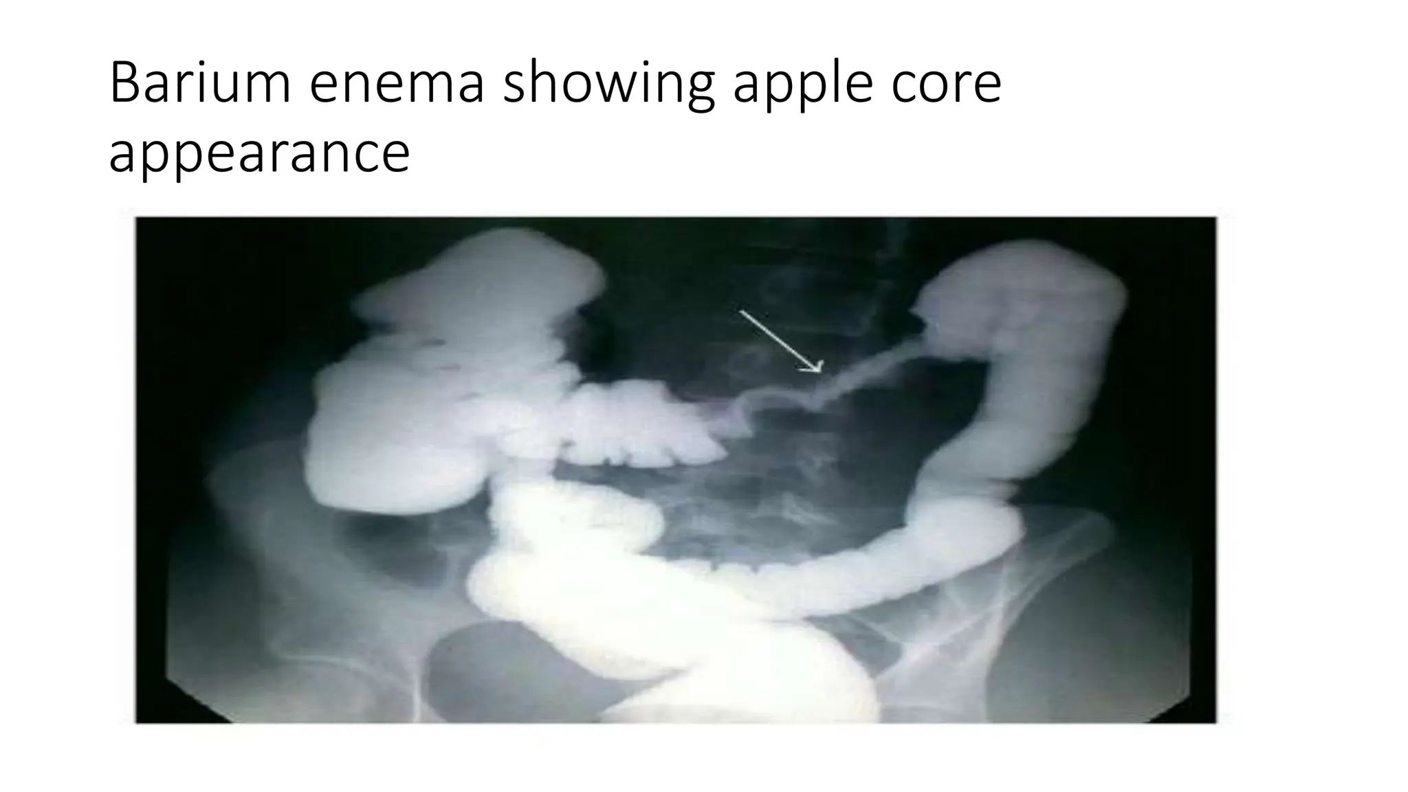 COLON CANCER causes and Management of the disease.pptx