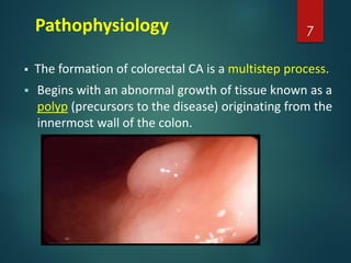 Colon cancer | PDF
