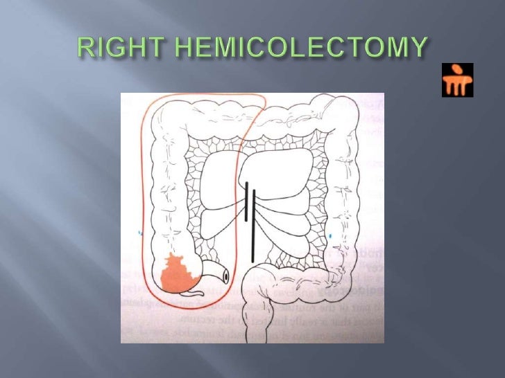 Colon Cancer 9th Sem