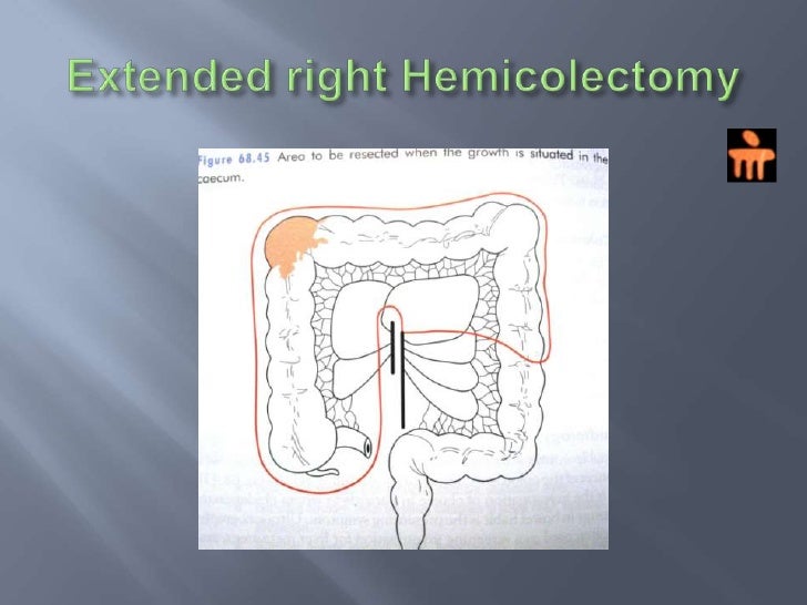 Colon Cancer 9th Sem