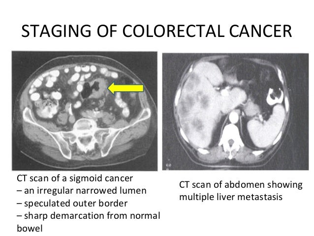Do Ct Scans Detect Colon Cancer Cancerwalls