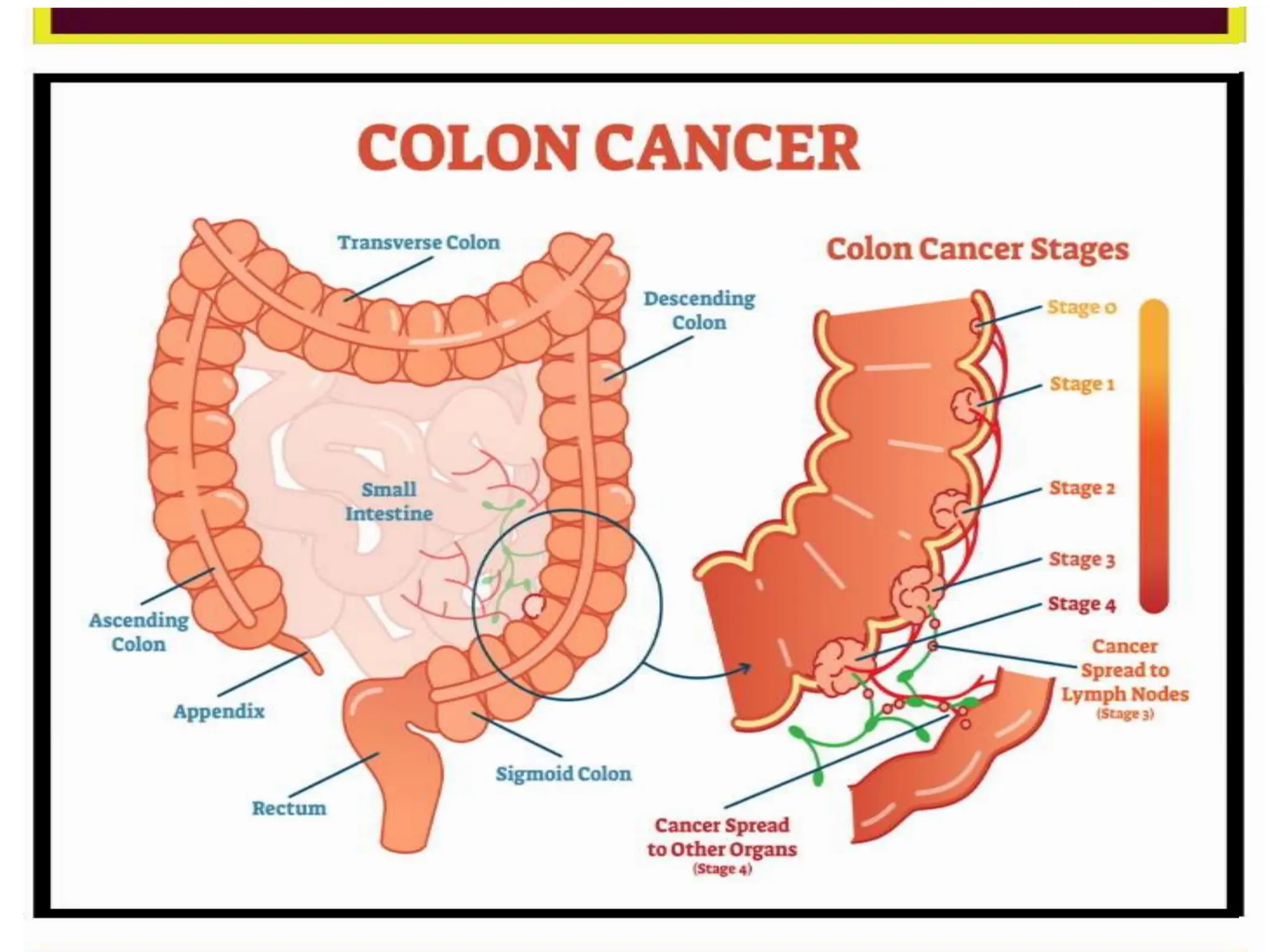 COLON CANCER Loreen.......... PowerPoint.pptx