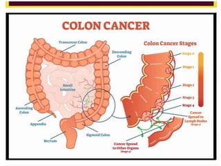 COLON CANCER Loreen.......... PowerPoint.pptx