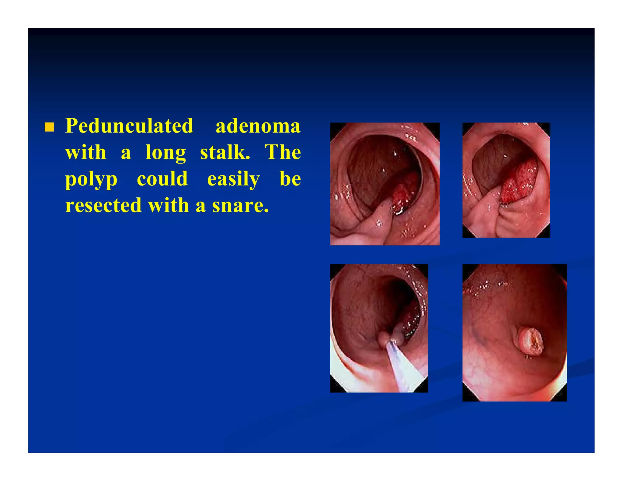 Colonic polyposis | PDF