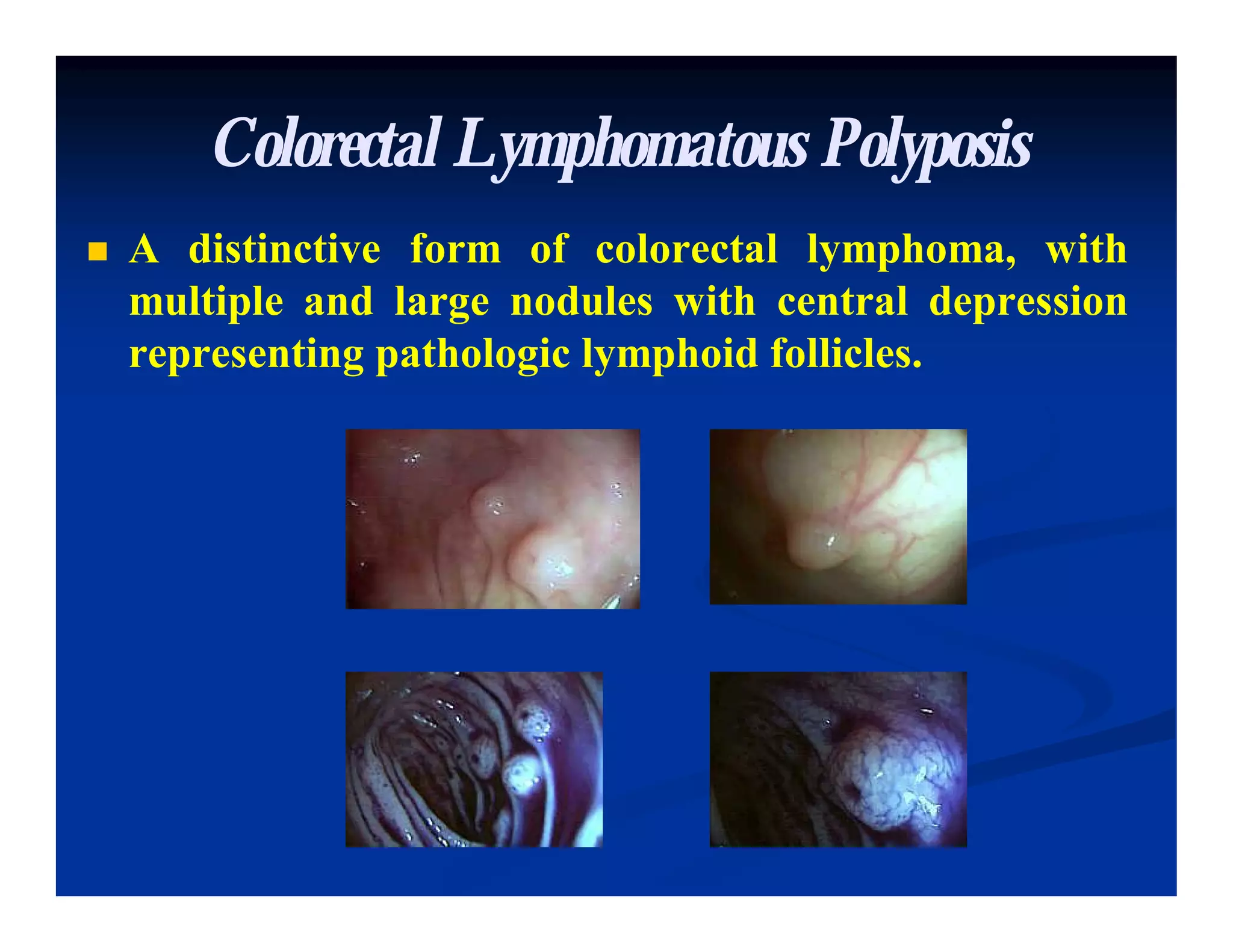 Colonic polyposis | PDF