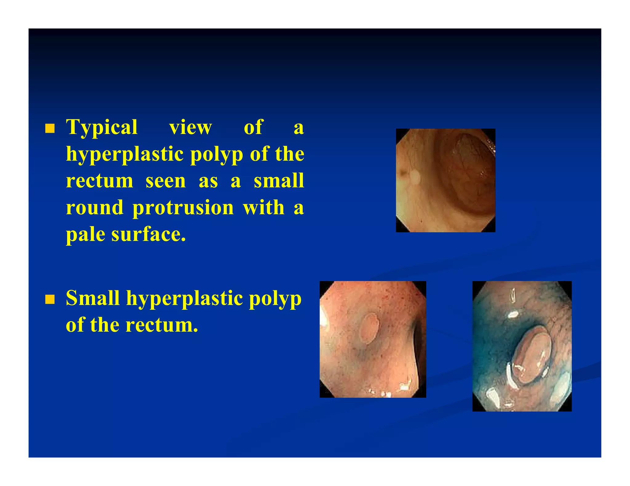 Colonic polyposis | PDF