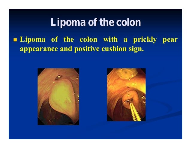Colonic polyposis
