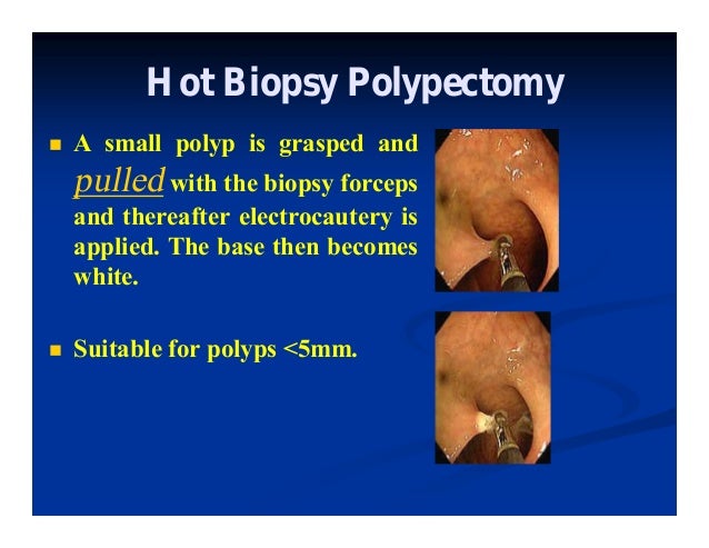 Colonic polyposis