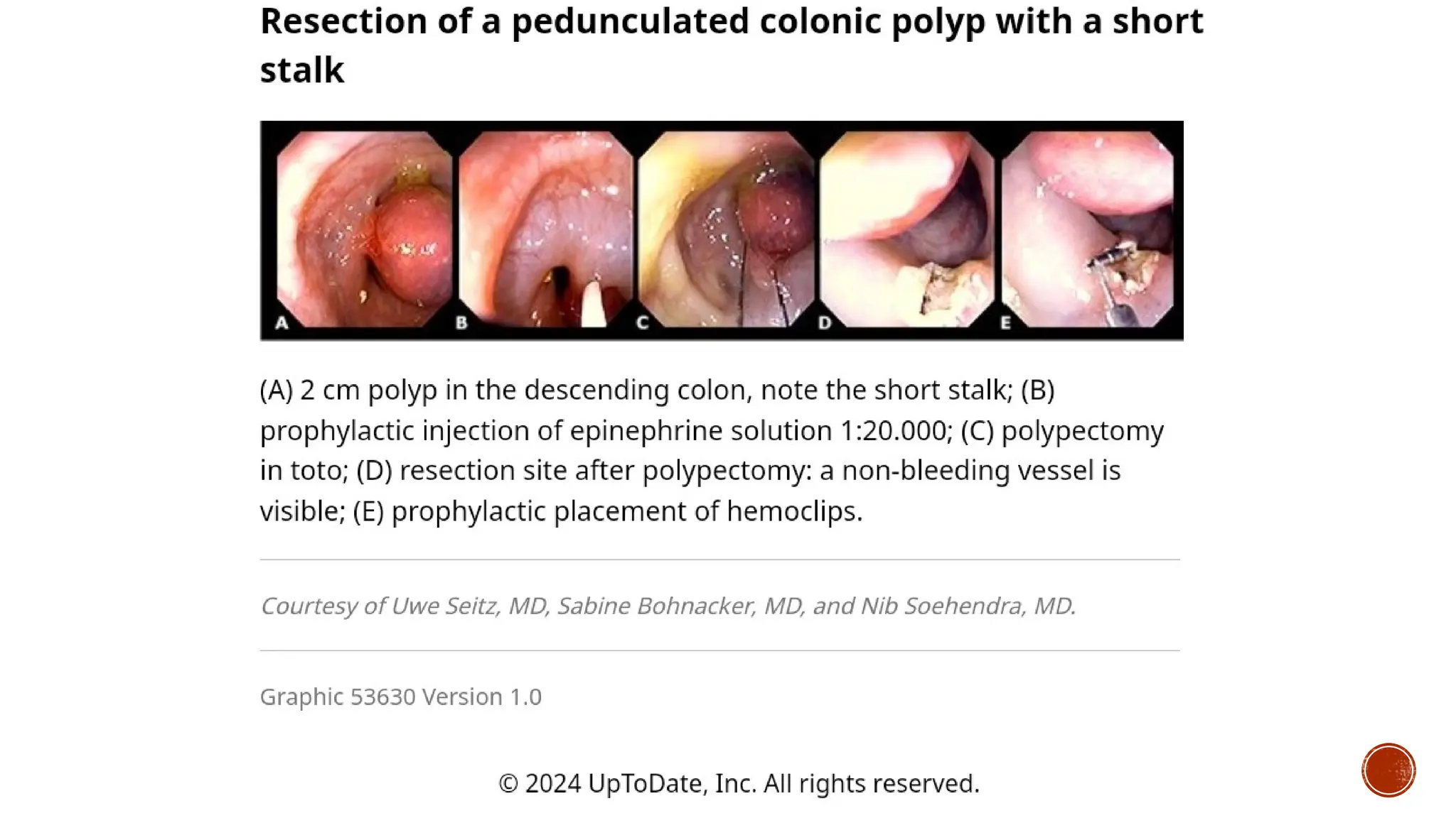 Polyps colonic Endoscopic finding power point.pptx