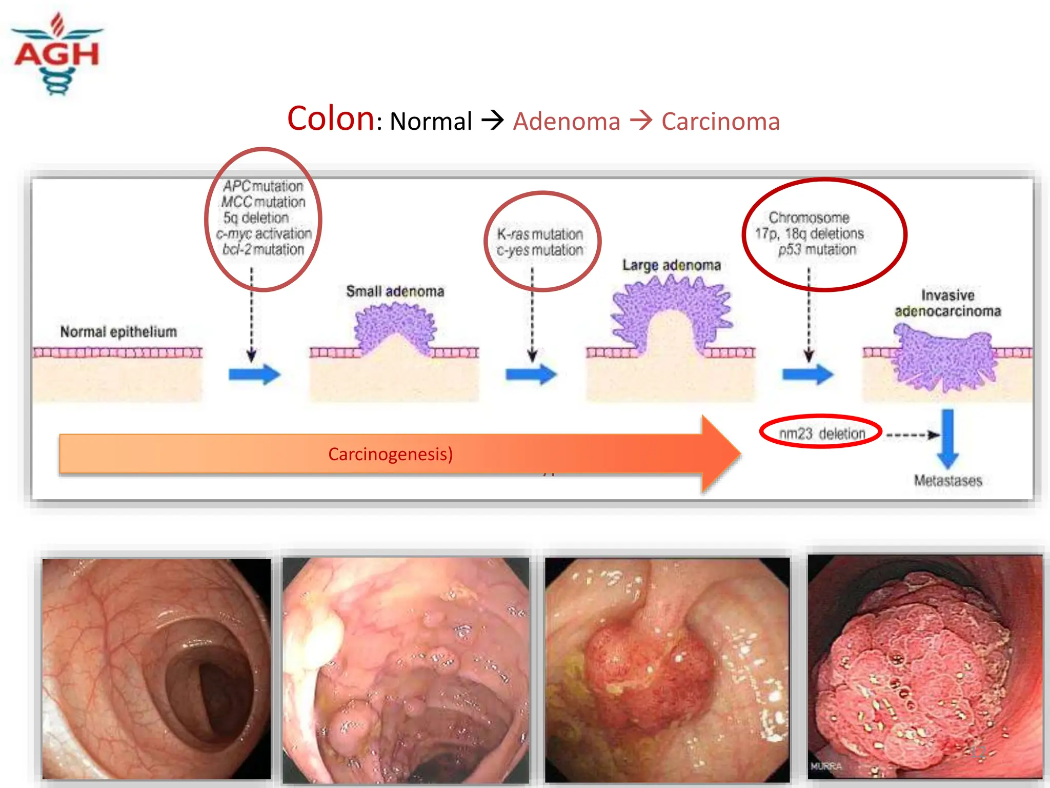 COLONIC POLYPS AND ITS FOLLOW UP PRESENTATION.pptx