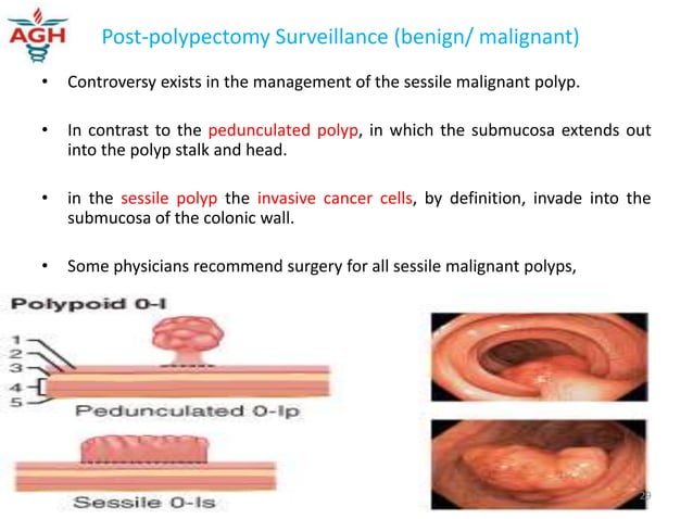 COLONIC POLYPS AND ITS FOLLOW UP PRESENTATION.pptx