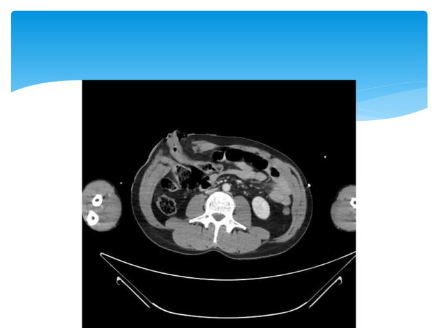 Colonic trauma | PPT