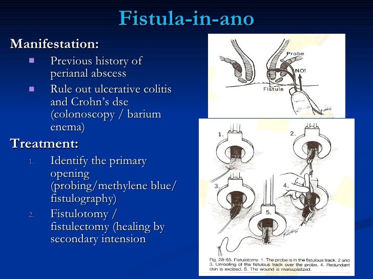 Fistula In Ano Types