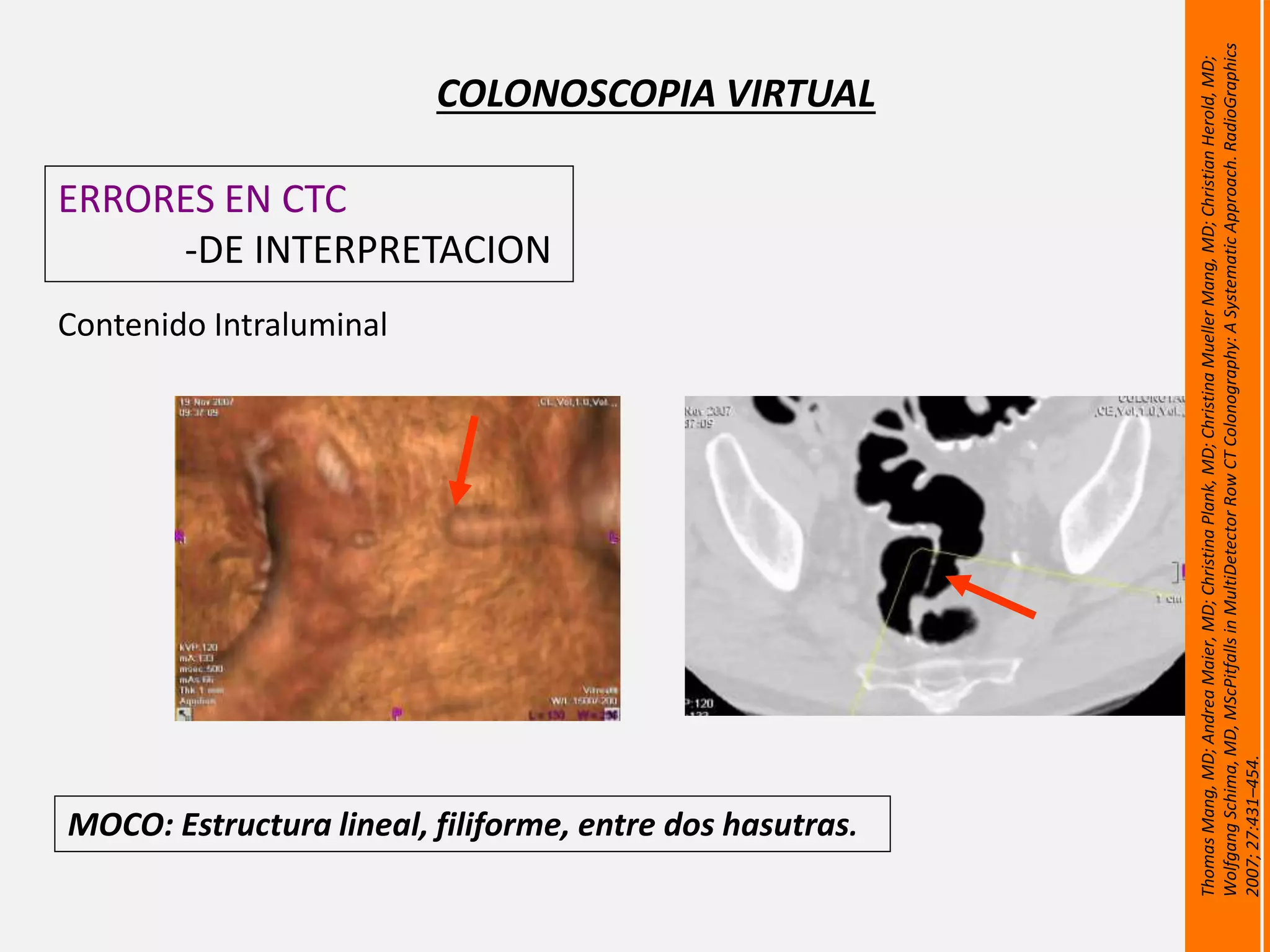 Colonografia por tac / USG endoanal | PPT | Descarga Gratuita