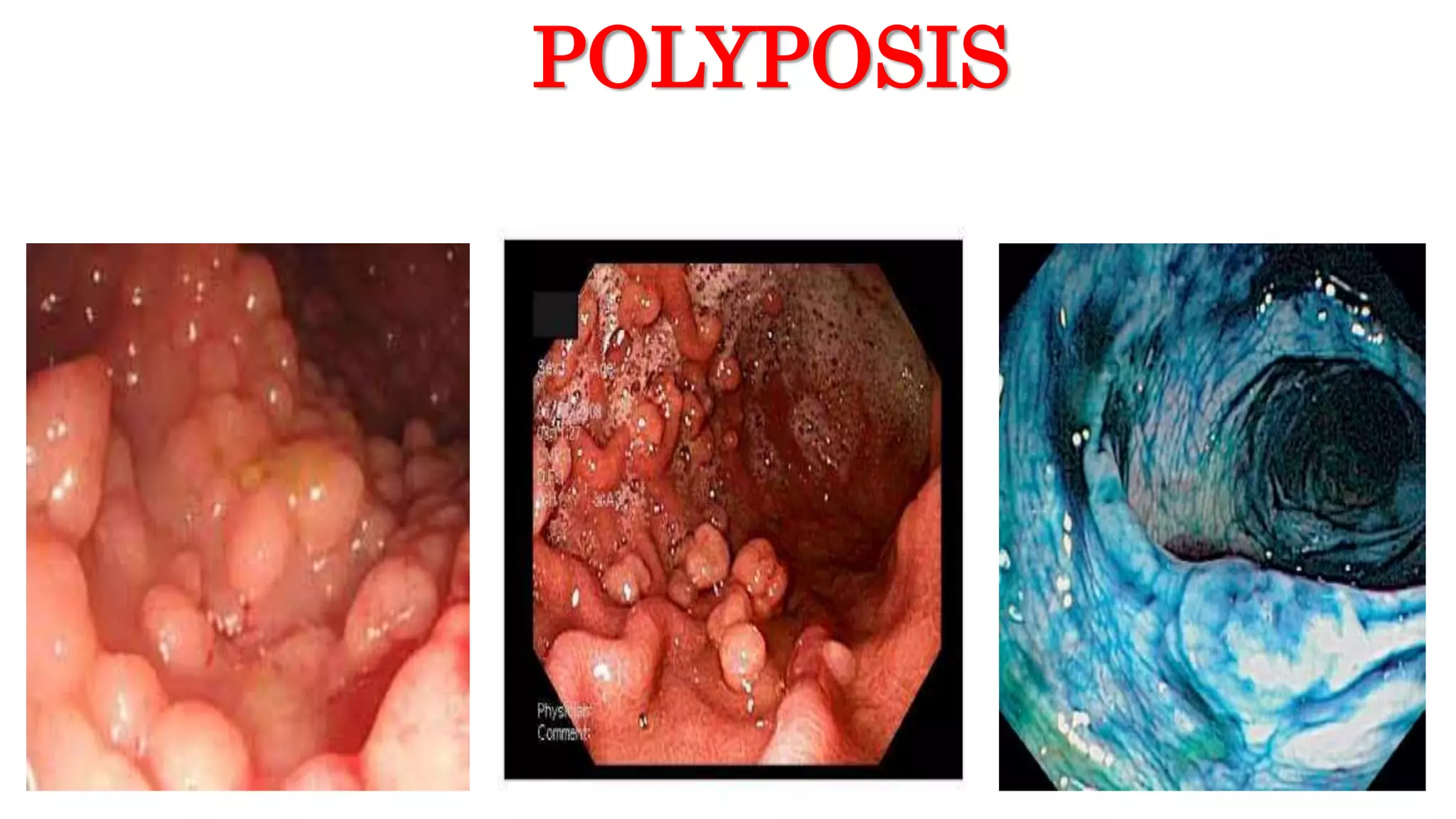 Colonoscopy A Pictorial Overview Pptx
