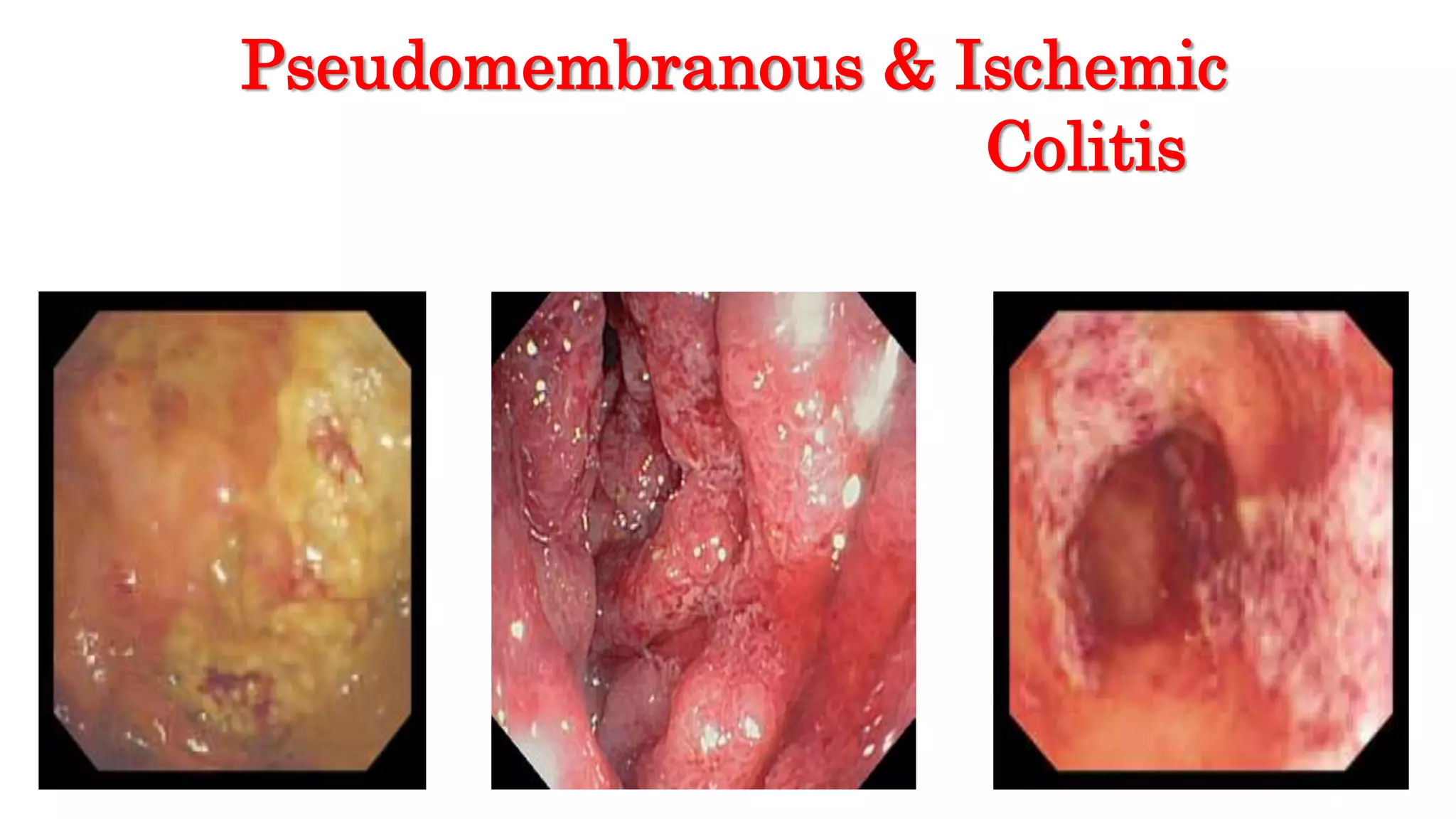 Colonoscopy- A Pictorial Overview | PPTX