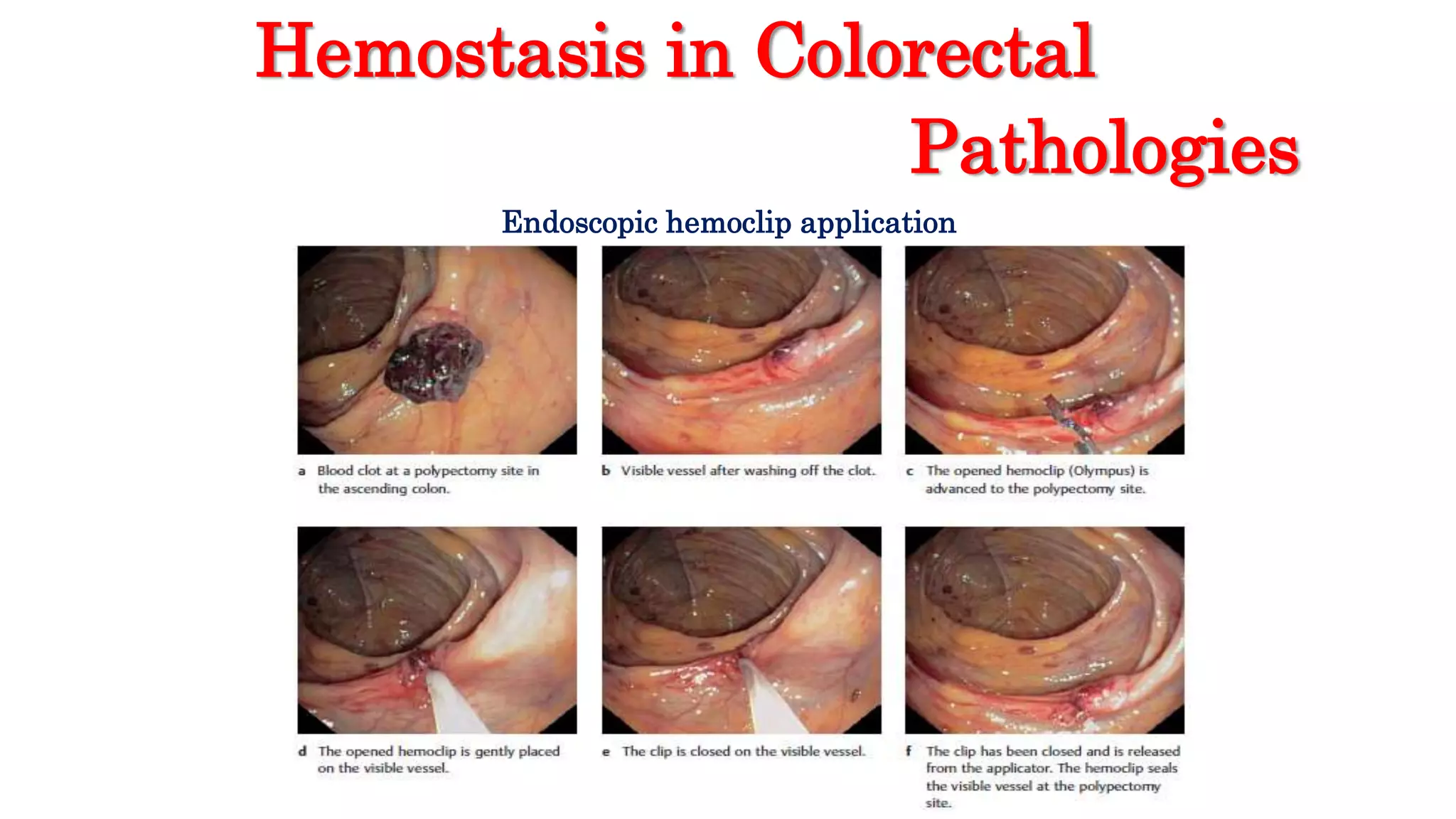 Colonoscopy A Pictorial Overview Pptx
