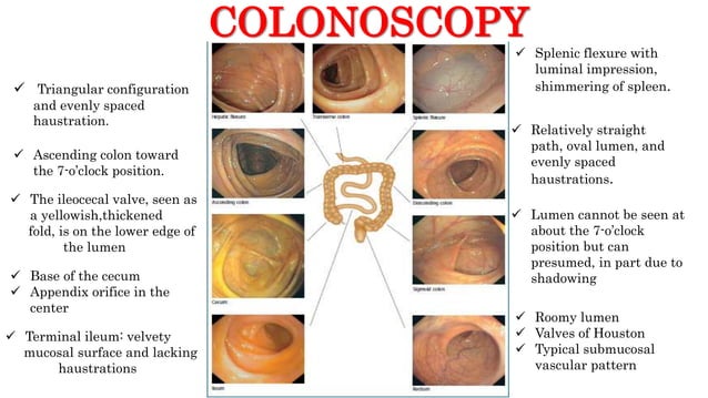 Colonoscopy- A Pictorial Overview | PPTX | Digestive Disorders ...