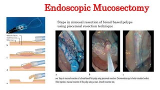 Colonoscopy- A Pictorial Overview | PPTX