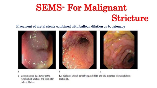 Colonoscopy- A Pictorial Overview | PPTX | Digestive Disorders | Diseases and Conditions