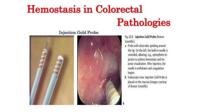 Colonoscopy- A Pictorial Overview | PPT