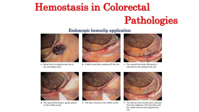 Colonoscopy- A Pictorial Overview | PPTX | Digestive Disorders ...