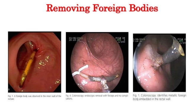 Colonoscopy A Pictorial Overview Pptx Digestive Disorders Diseases And Conditions