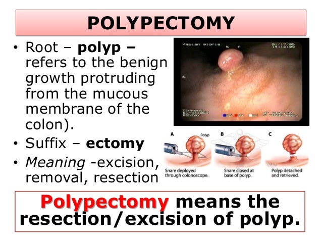 Colonoscopy with polypectomy