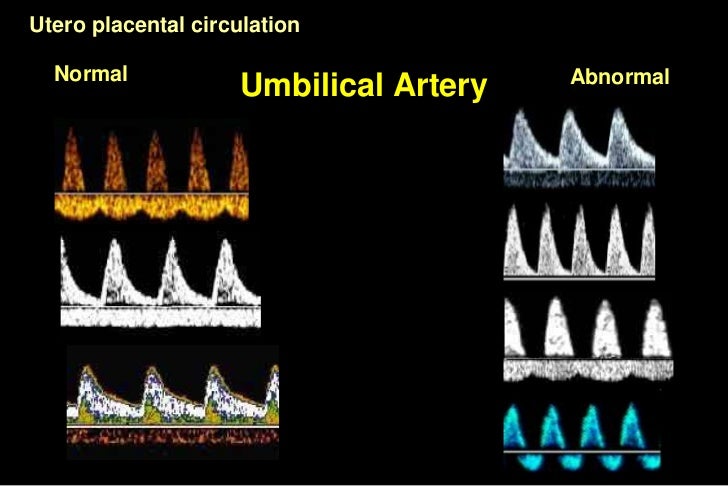 C O L O R D O P P L E R I N F E T A L H Y P O X I A