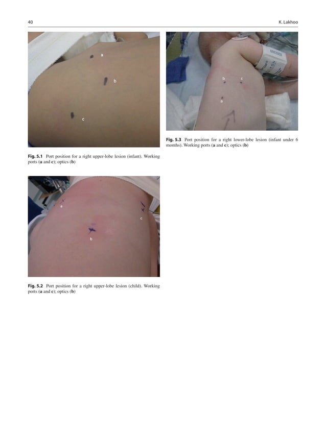 Color atlas of pediatric anatomy, laparoscopy, | PDF