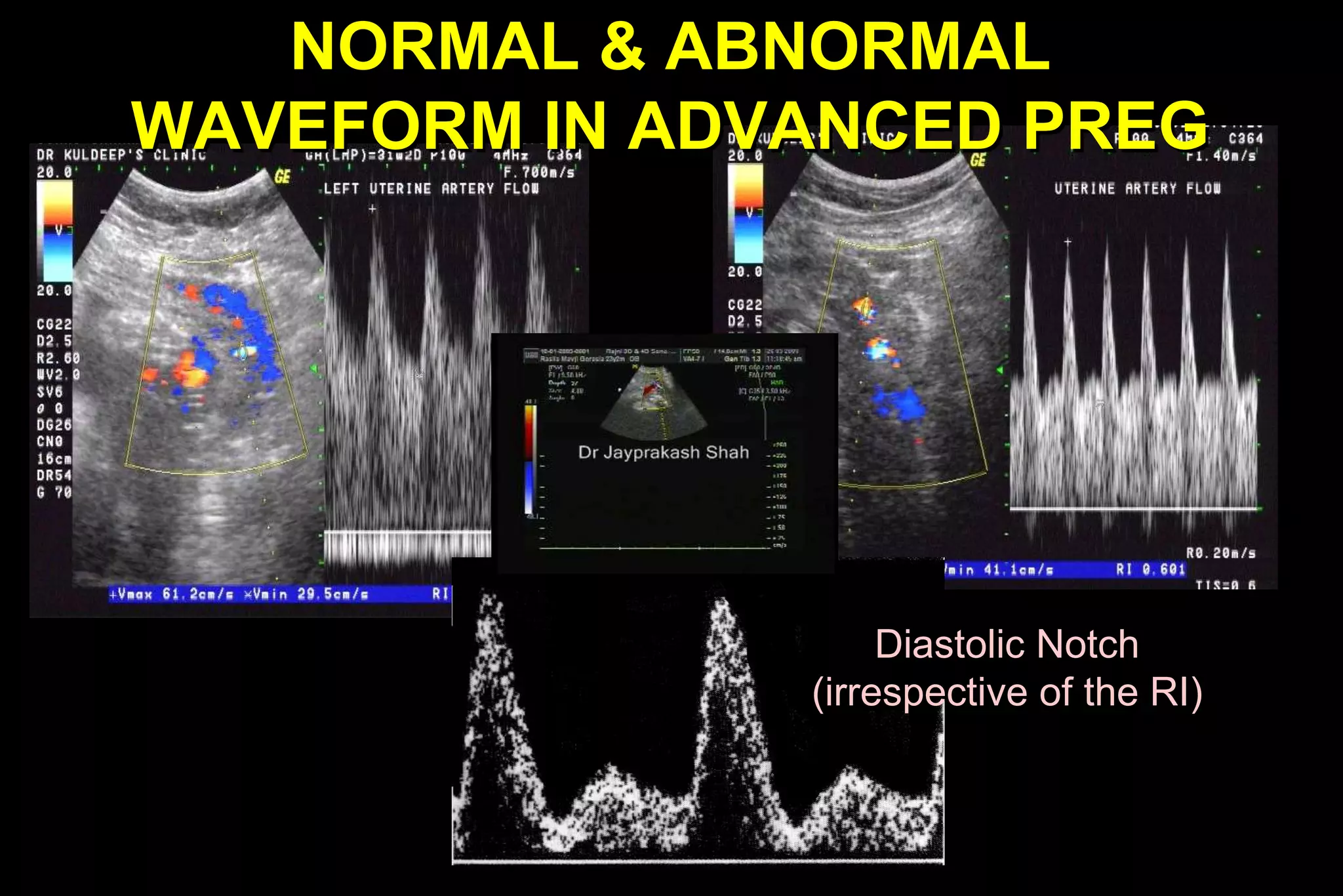 Color doppler in fetal hypoxia | PPTX