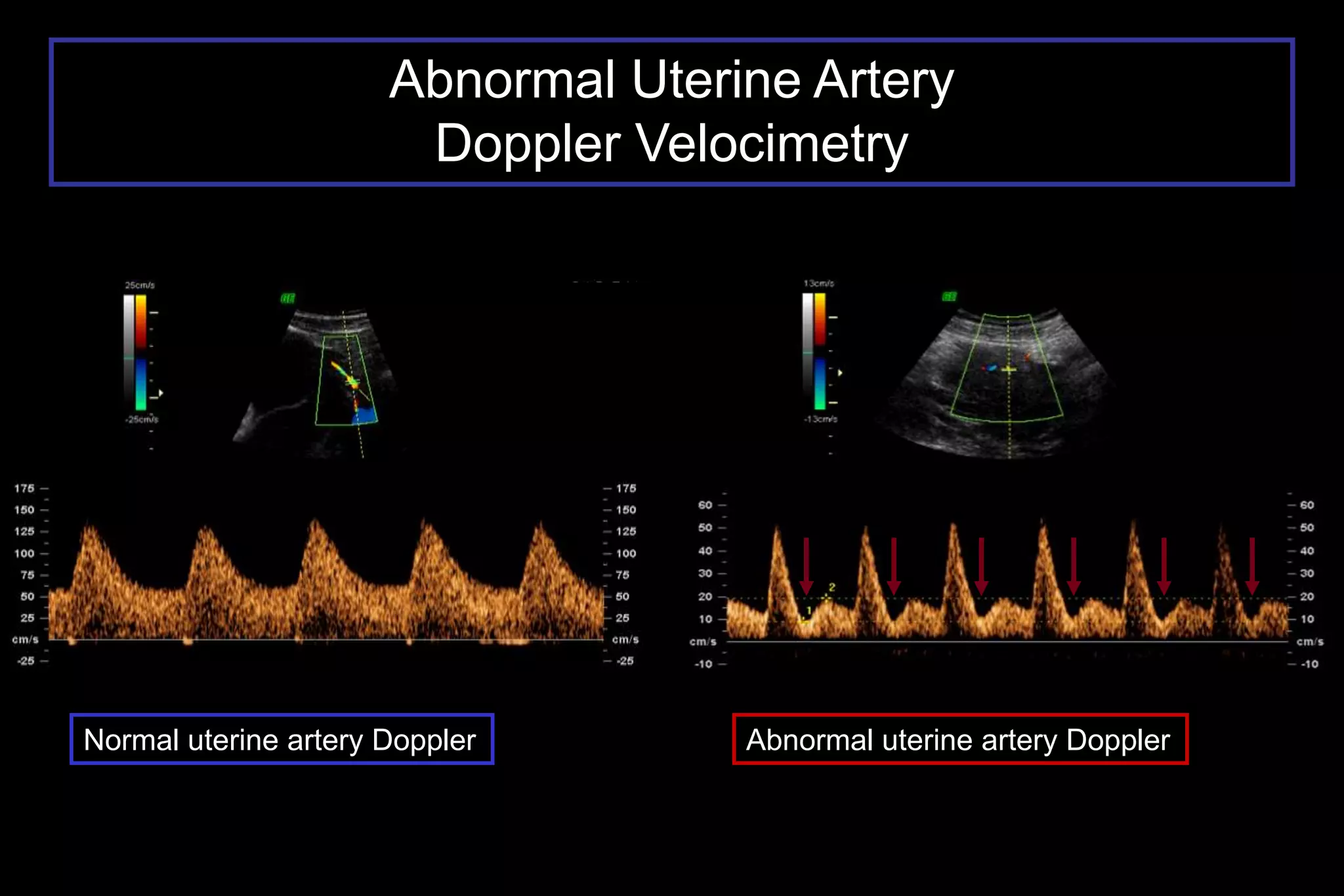 Color doppler in fetal hypoxia | PPTX